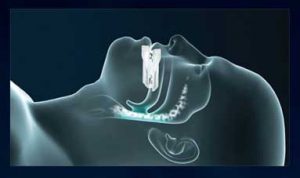 PureSleep Review 2022 - Anti-Snoring MouthPiece Pros and Cons