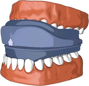 TheraSnore Review - UK's Leading Snoring Device